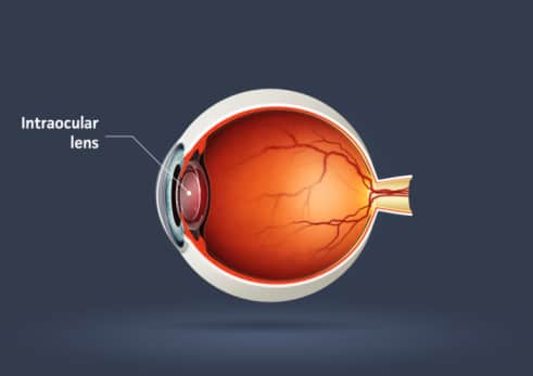 Everything You Need to Know About Intraocular Lenses